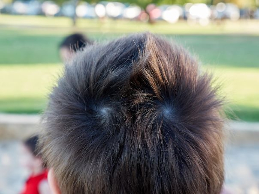 Interesting genetics: 30 people with a rare anomalies - Pictolic