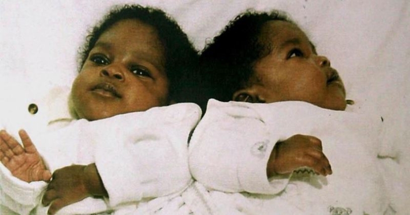 Siamese twins separated in infancy continue to sleep the same way as ...